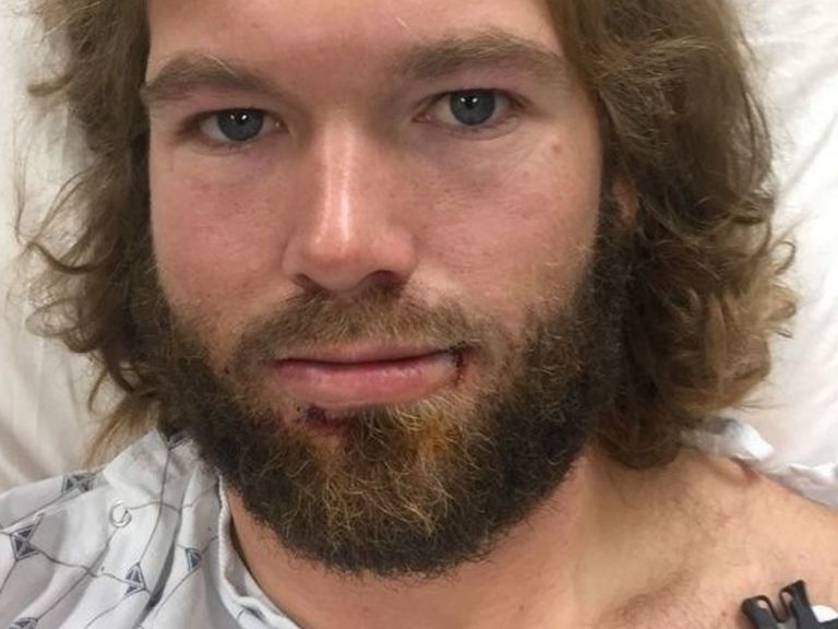 Look: Ski instructor's face impaled by branch | theScore.com
